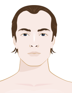 Tacha calva en la cabeza - alopecia areata y sus causas