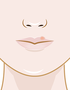 Granos en el labio - Cómo hacerlos desaparecer