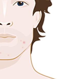 Cómo eliminar el pelo encarnado